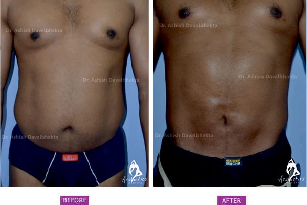 Remove undesirable fat with liposuction surgery at Pune's No.1 Clinic