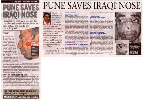 Rhinoplasty in Pune | Reshape Your Nose with Dr. Ashish Davalbhakta